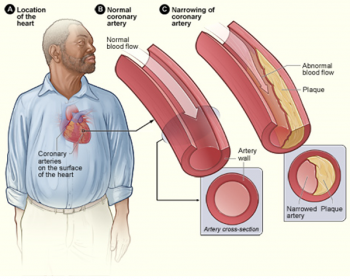 14.6 Cardiovascular Disease – Human Biology